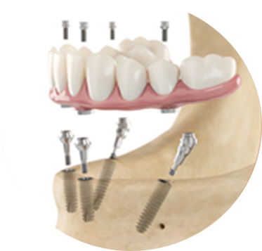 DentalImplantHub – Dental Implant Hub